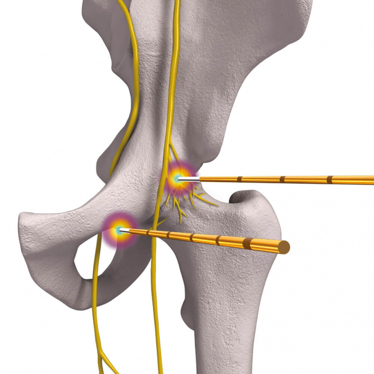 COOLIEF para tratamiento de dolor crónico – Salvamédica