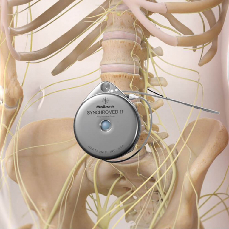 Bomba implantable de infusión intratecal para tratamiento de dolor ...